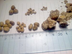 Ubat Batu Karang (Kidney Stones Medication), Pilihan Rawatan Untuk Anda ...